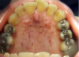 Oral Petechiae